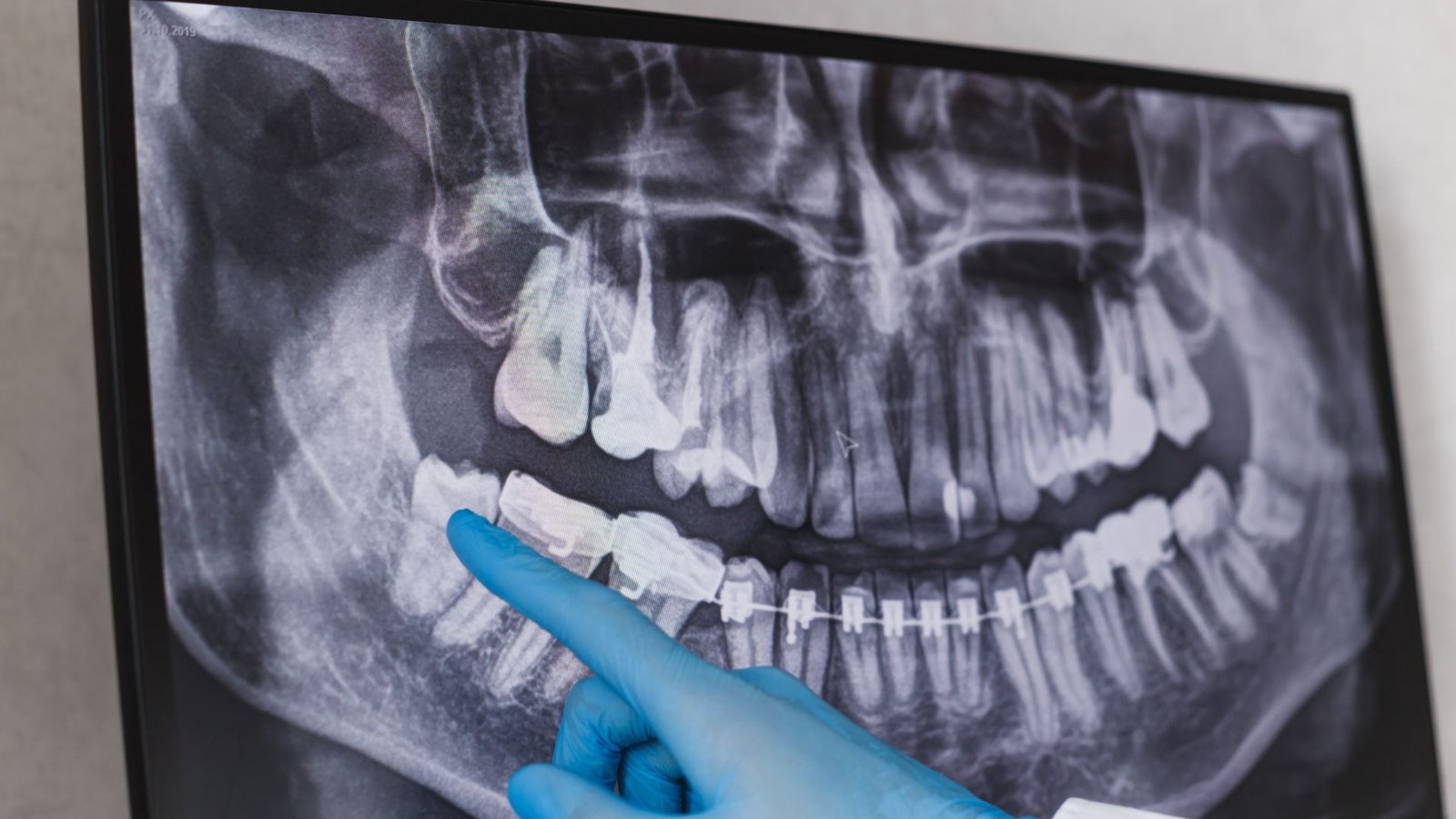 Pineapple Juice and Wisdom Teeth: Everything You Need to Know
